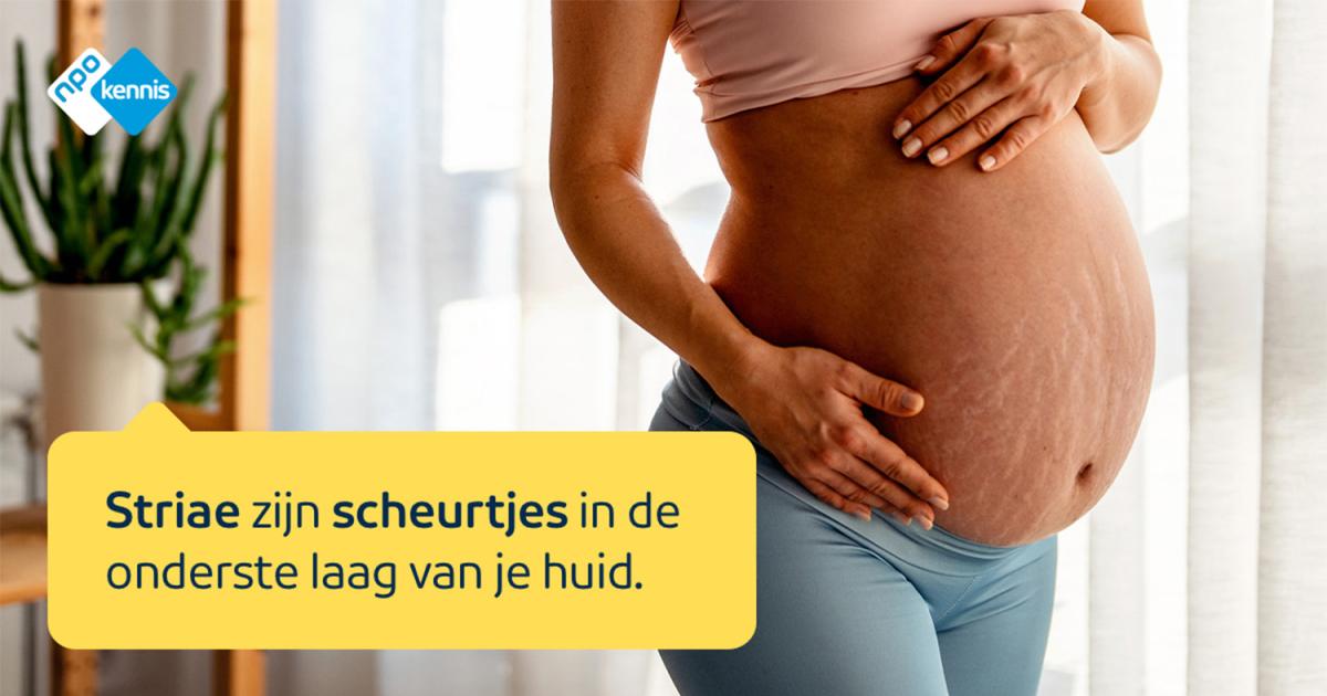 Hoe ontstaat striae? | NPO Kennis